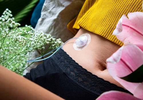 Insulinpumpe - guide til hvor du kan placere den | Mitliv.dk